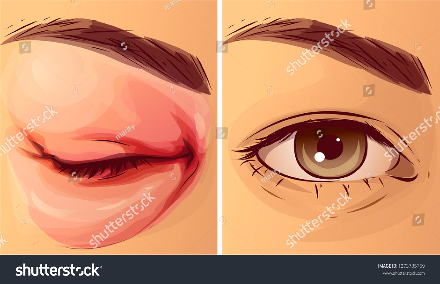 Swollen Eye Beforeafter Vector Illustration: vetor stock (livre de ...