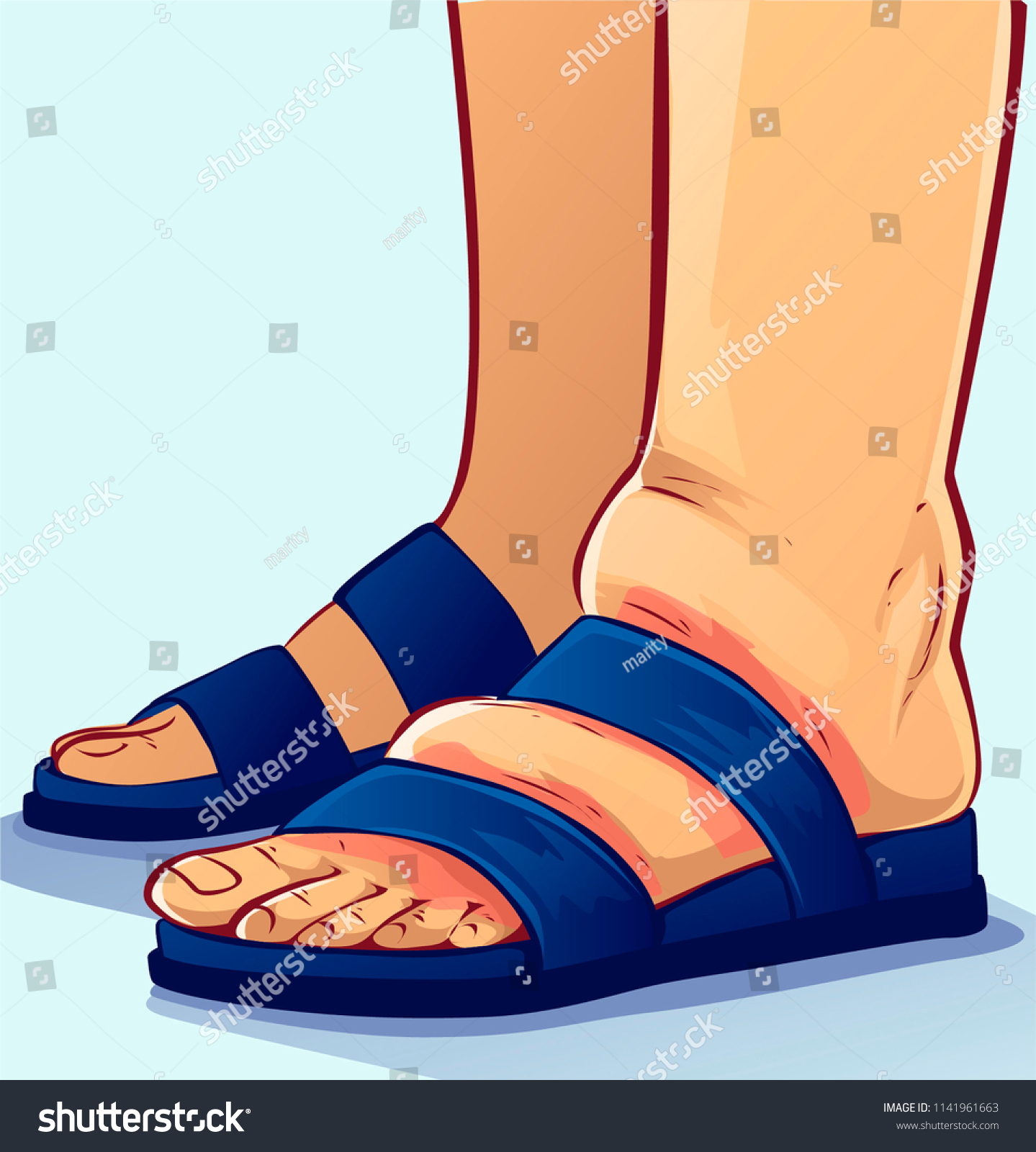 Swollen Feet Vector Illustration: เวกเตอร์สต็อก (ปลอดค่าลิขสิทธิ์ ...