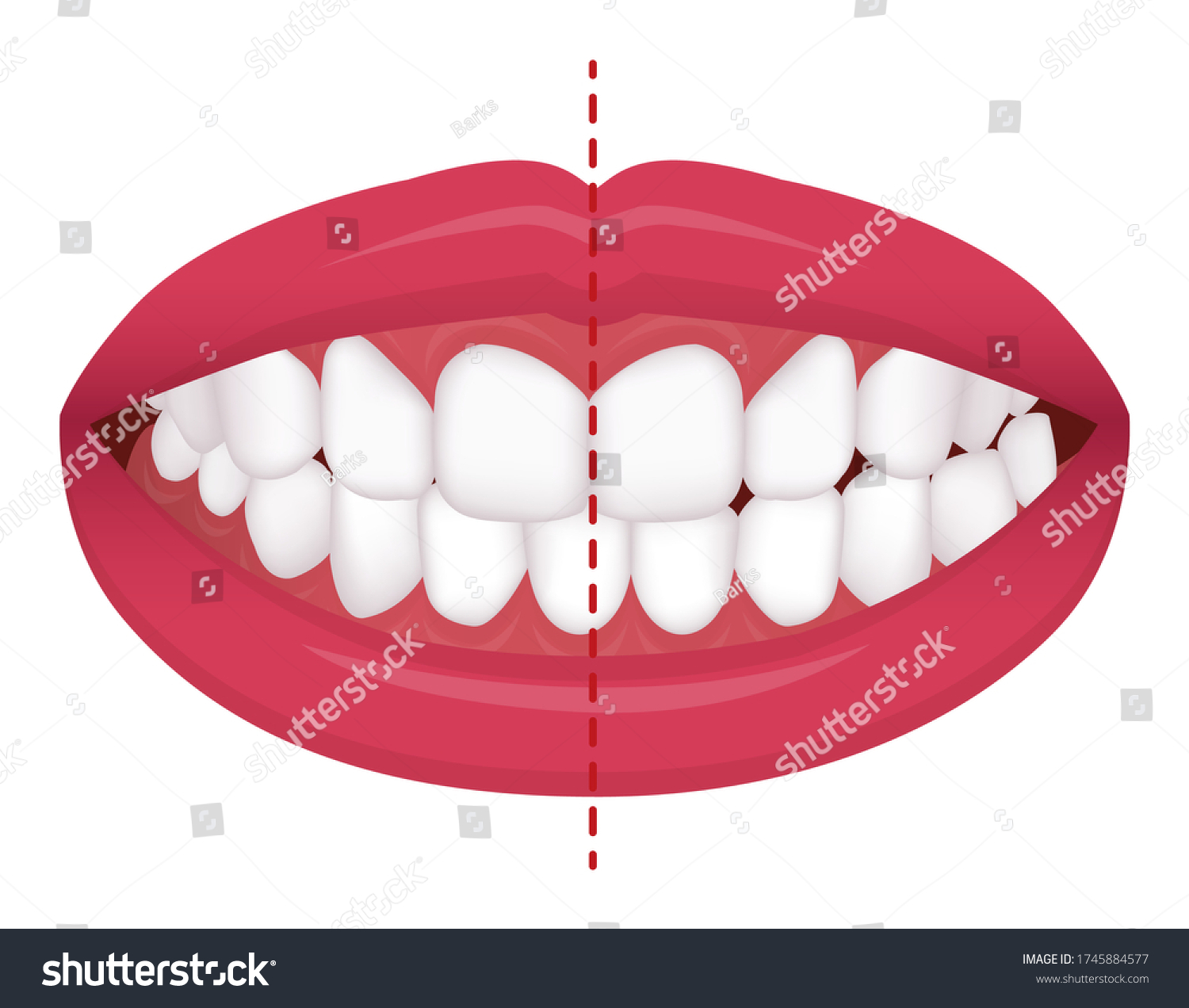 Teeth Trouble Bite Type Crooked Teeth Stock Vector (Royalty Free ...