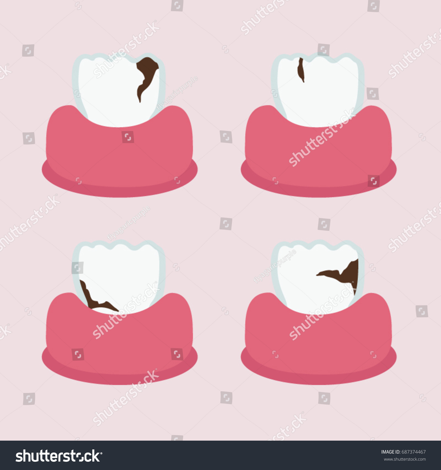 Teeth Cavities Vector Illustration Stock Vector (Royalty Free) 687374467