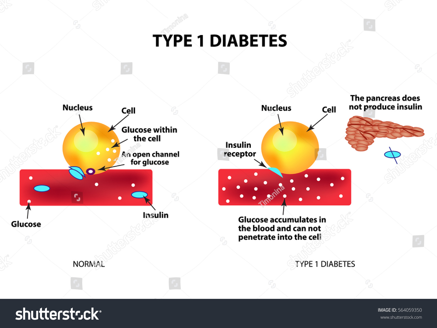 Absorption Glucose By Cell Type 1 Stock Vector 564059350 - Shutterstock