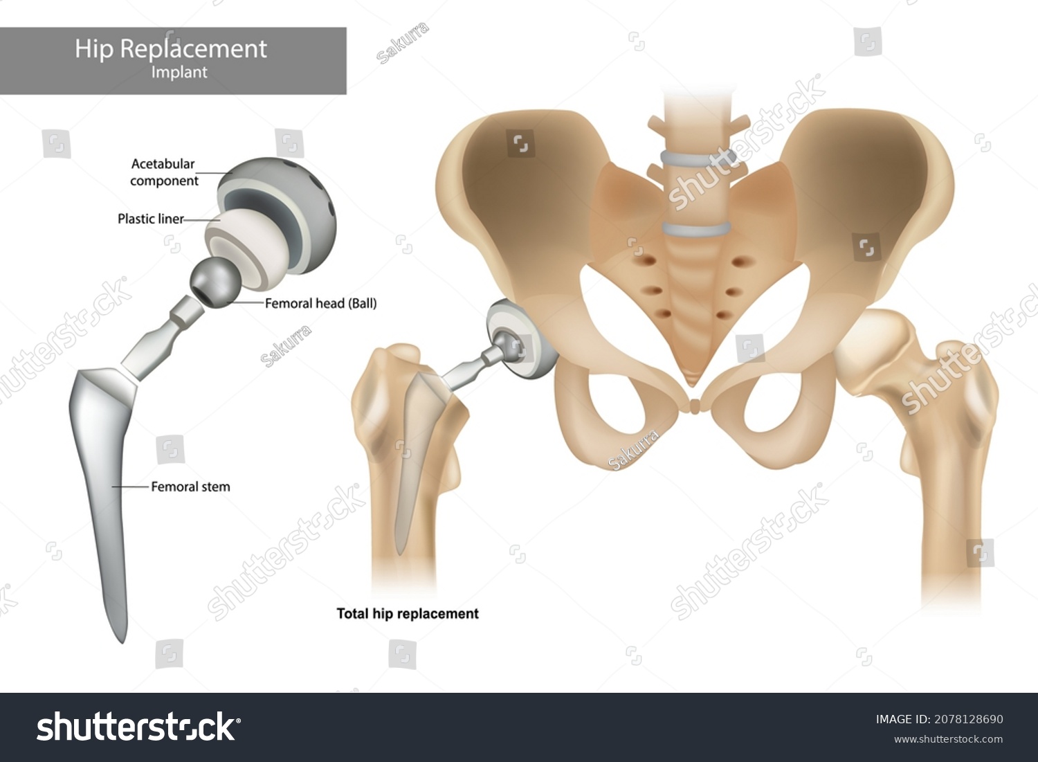 Total Hip Replacement Components Hip Implant Stock Vector (Royalty Free ...