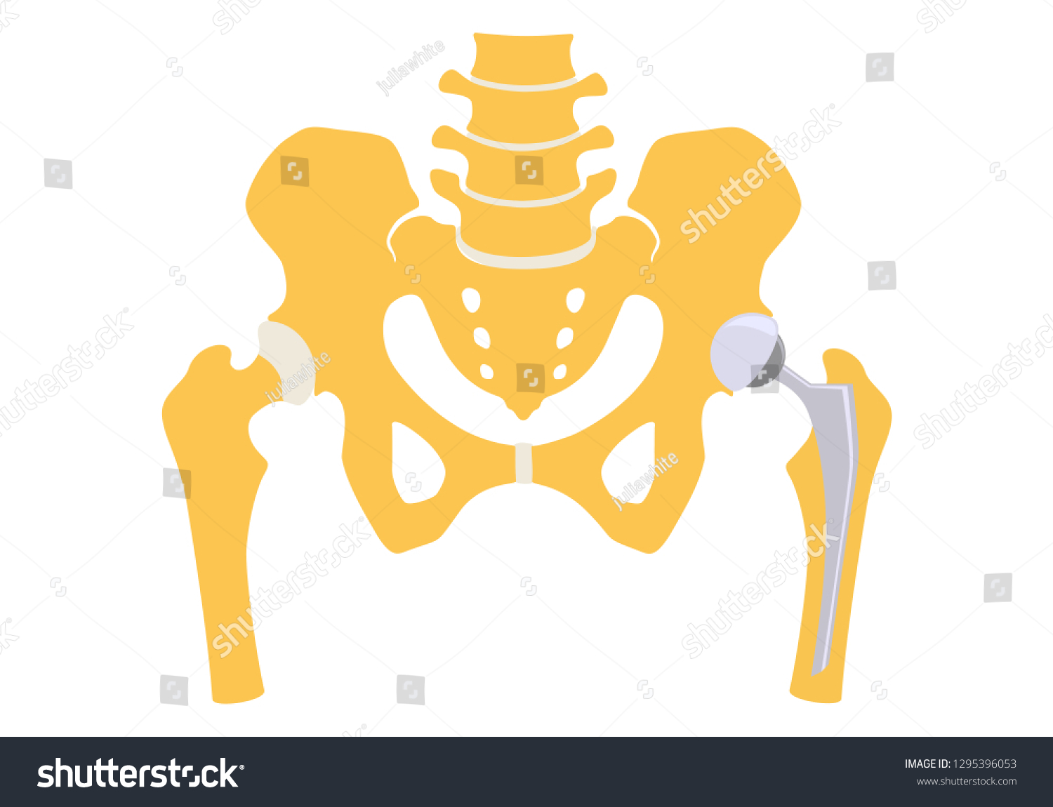Vektor Stok Total Hip Replacement Vector Illustration (Tanpa Royalti ...