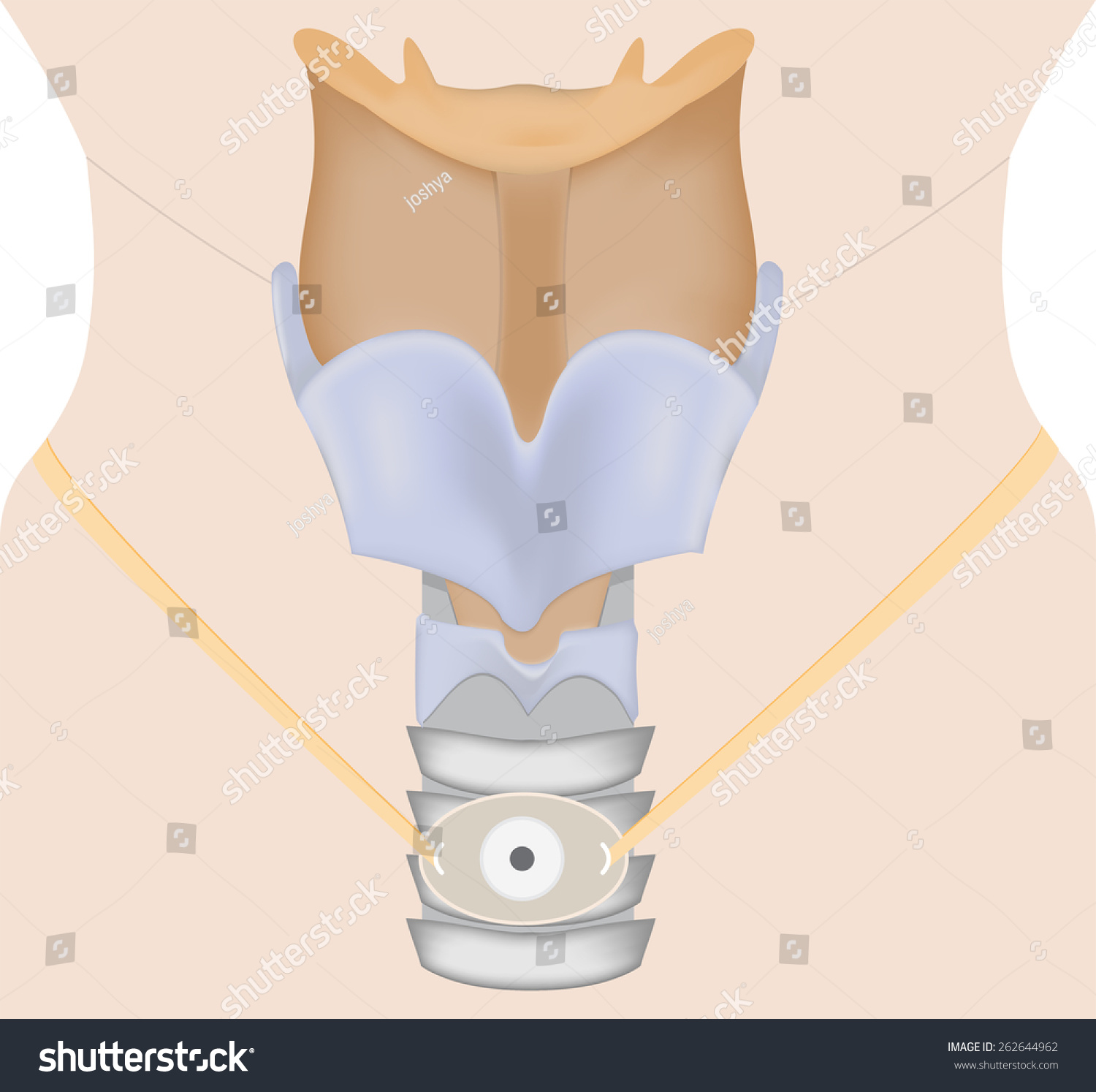 Tracheostomy Illustration - 262644962 : Shutterstock