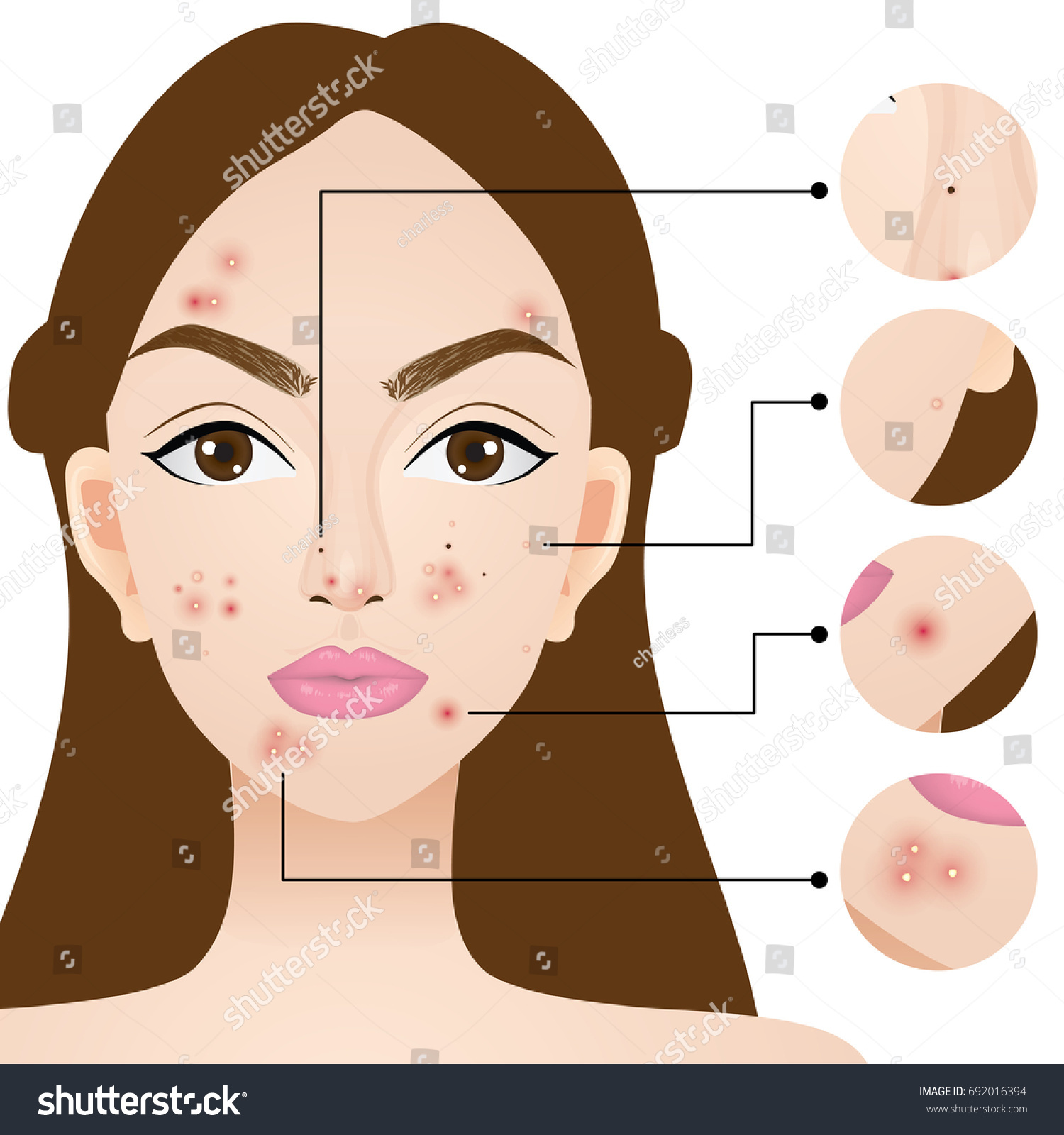 soorten acne, huidproblemen vector illustratie: stockvector ...