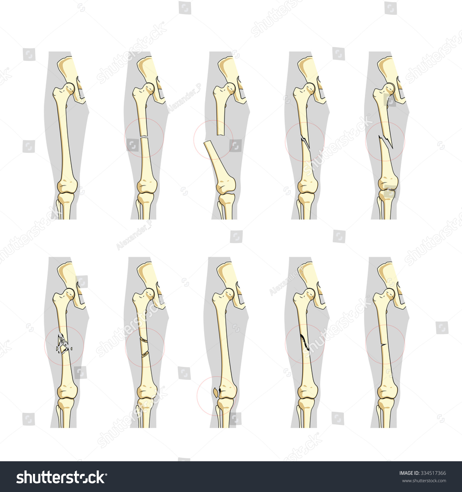 Vektor Stok Types Bone Fractures Medical Skeleton Anatomy (Tanpa ... Vektor Stok Types Bone Fractures Medical Skeleton Anatomy (Tanpa ...