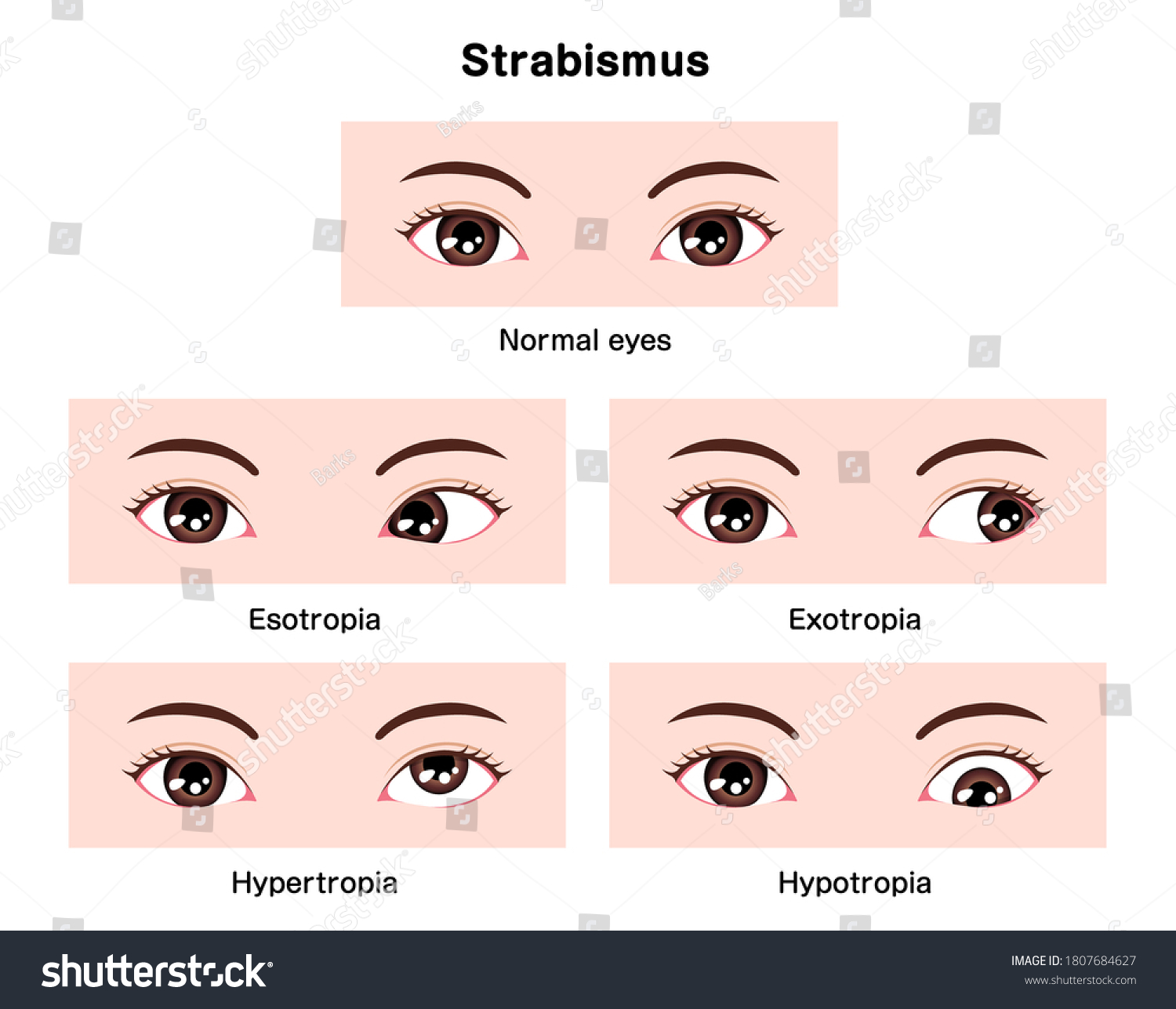 Types Strabismus Vector Illustration Stock Vector (Royalty Free ... Types Strabismus Vector Illustration Stock Vector (Royalty Free ...