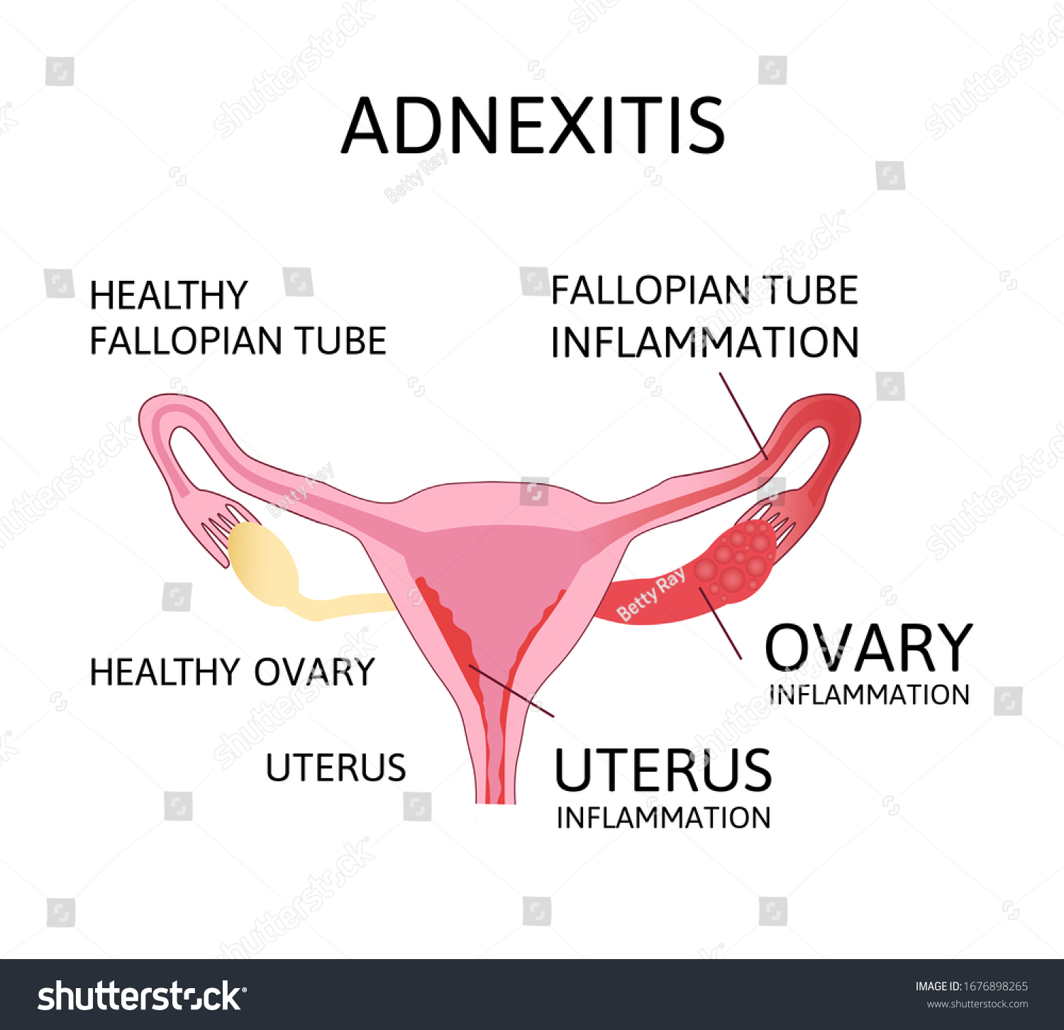 Uterus Ovaries Scheme Adnexitis Infection Inflammation Stock Vector