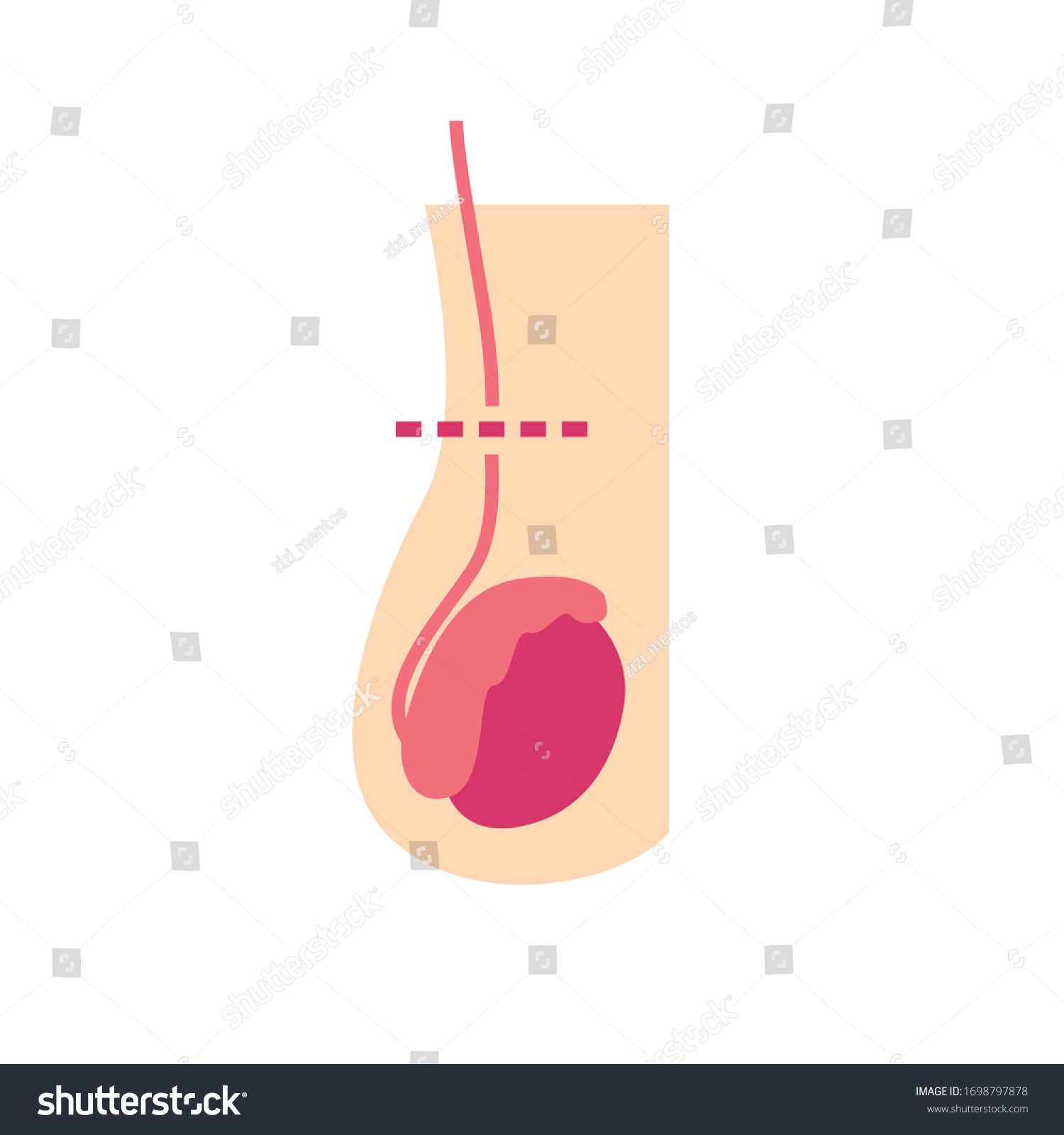 Vasectomy Flat Icon Vector Illustration Stock Vector (Royalty Free) 1698797878