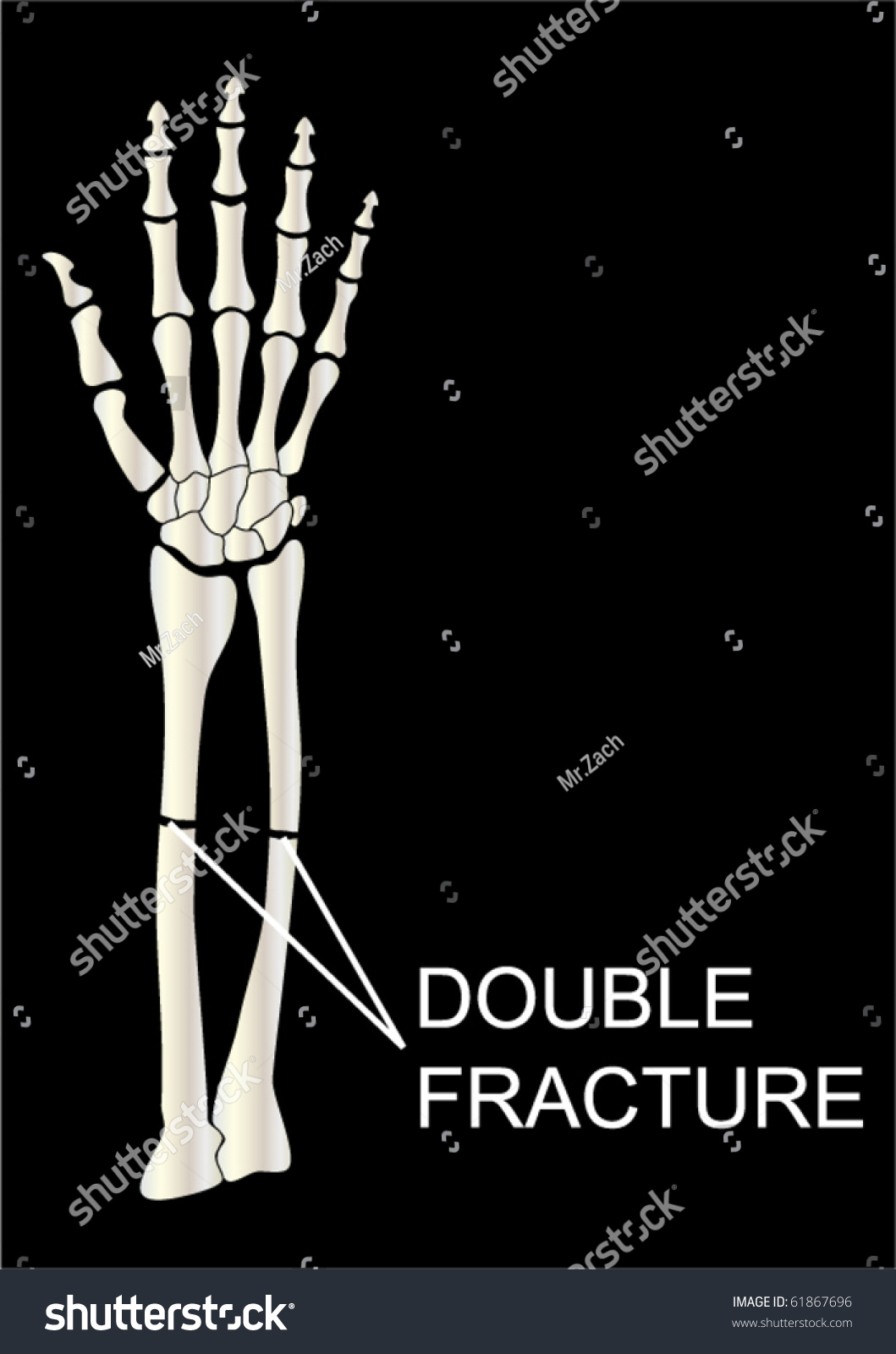 Vector Human Hand Bones Double Fracture Stock Vector (Royalty Free ...