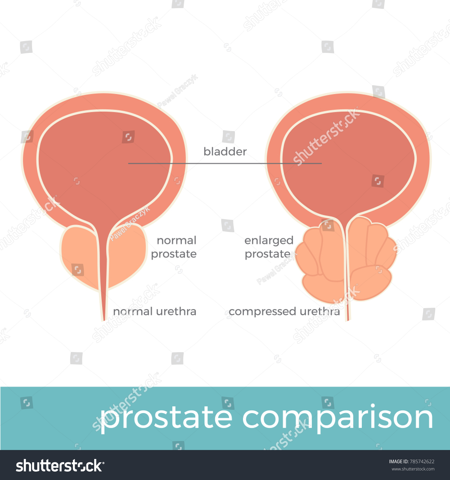 Vector Illustration Normal Enlarged Prostate Comparison Stock Vector Royalty Free 785742622