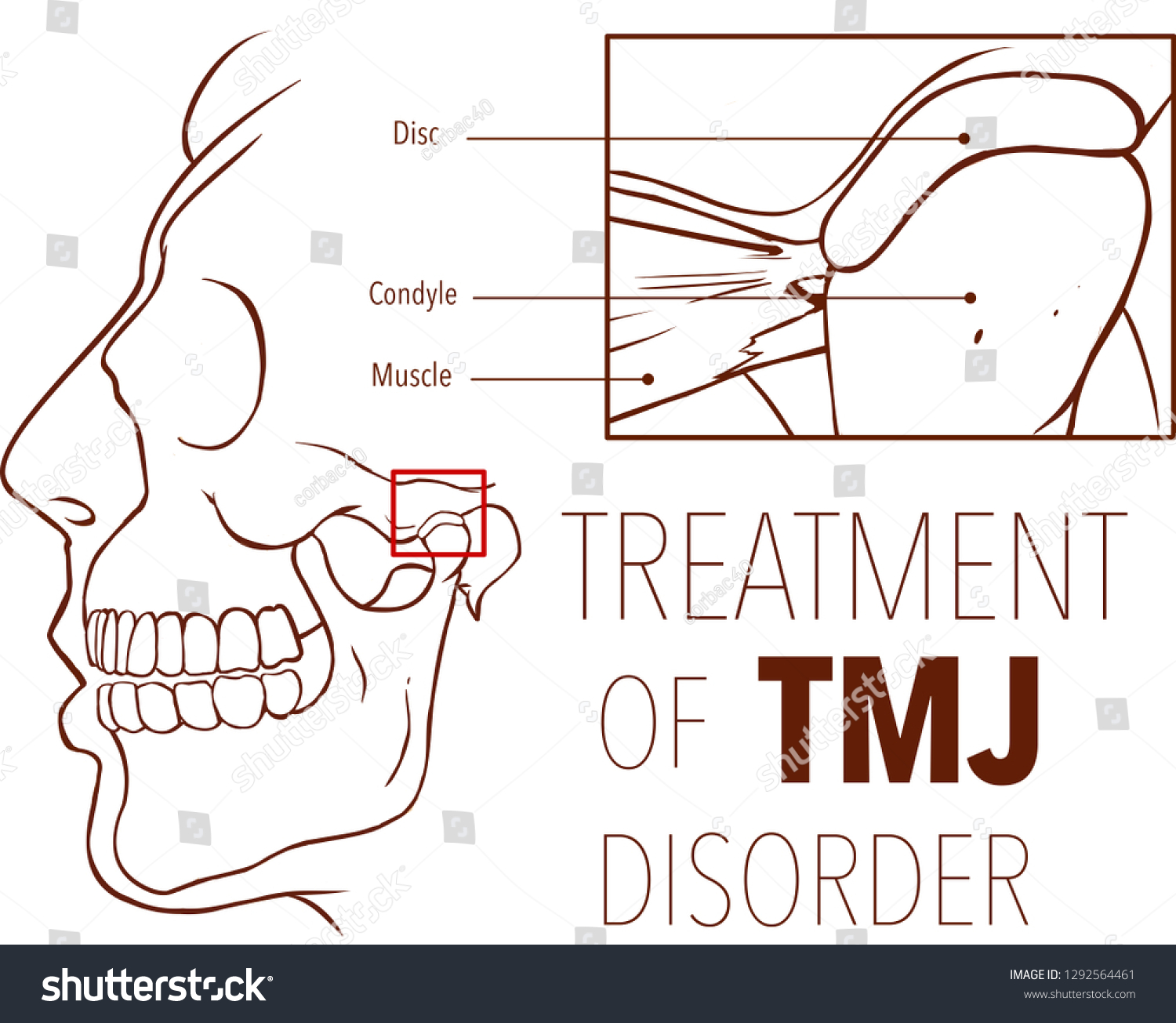 Vector Illustration Treatment Tmj Disorder Stock Vector Royalty Free