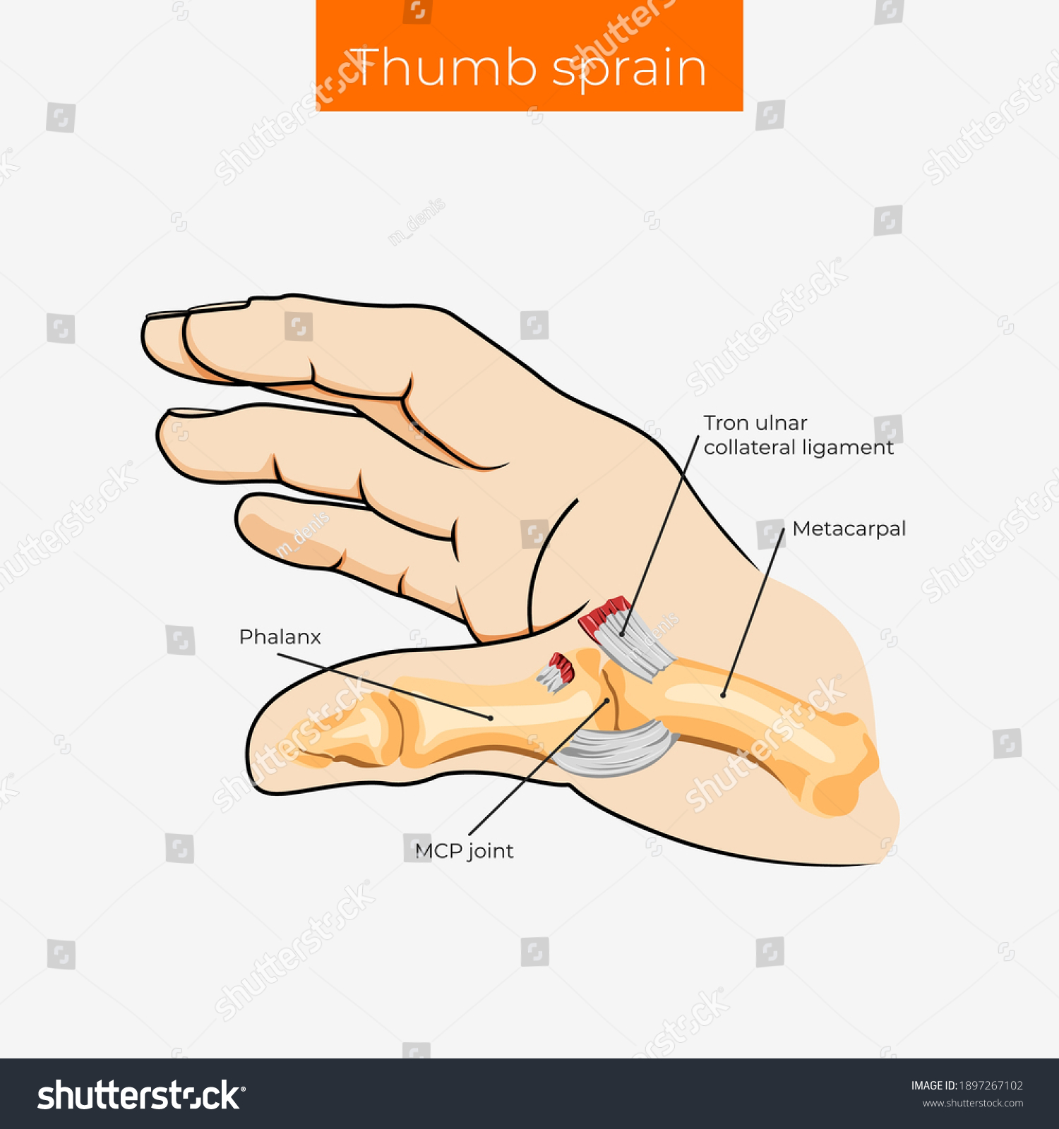 Vector Illustration Thumb Sprain Poster Stock Vector (Royalty Free ...