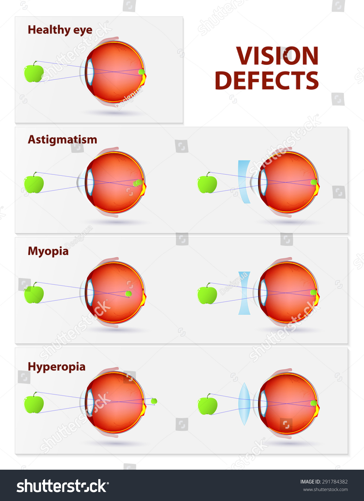 4,324 Vision defect Images, Stock Photos & Vectors | Shutterstock