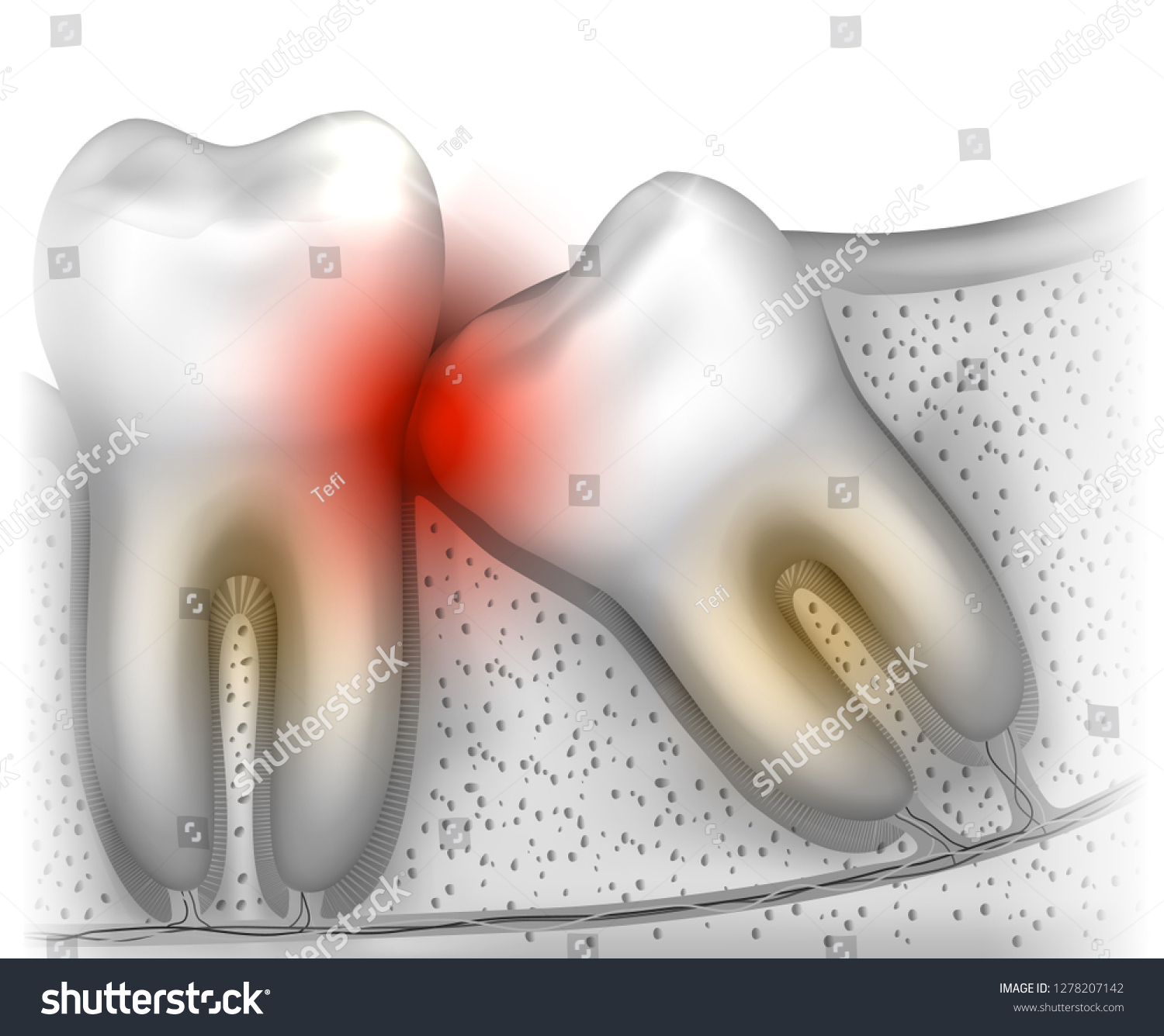 Wisdom Tooth Eruption Problems Illustrated Anatomy: เวกเตอร์สต็อก (ปลอด ...