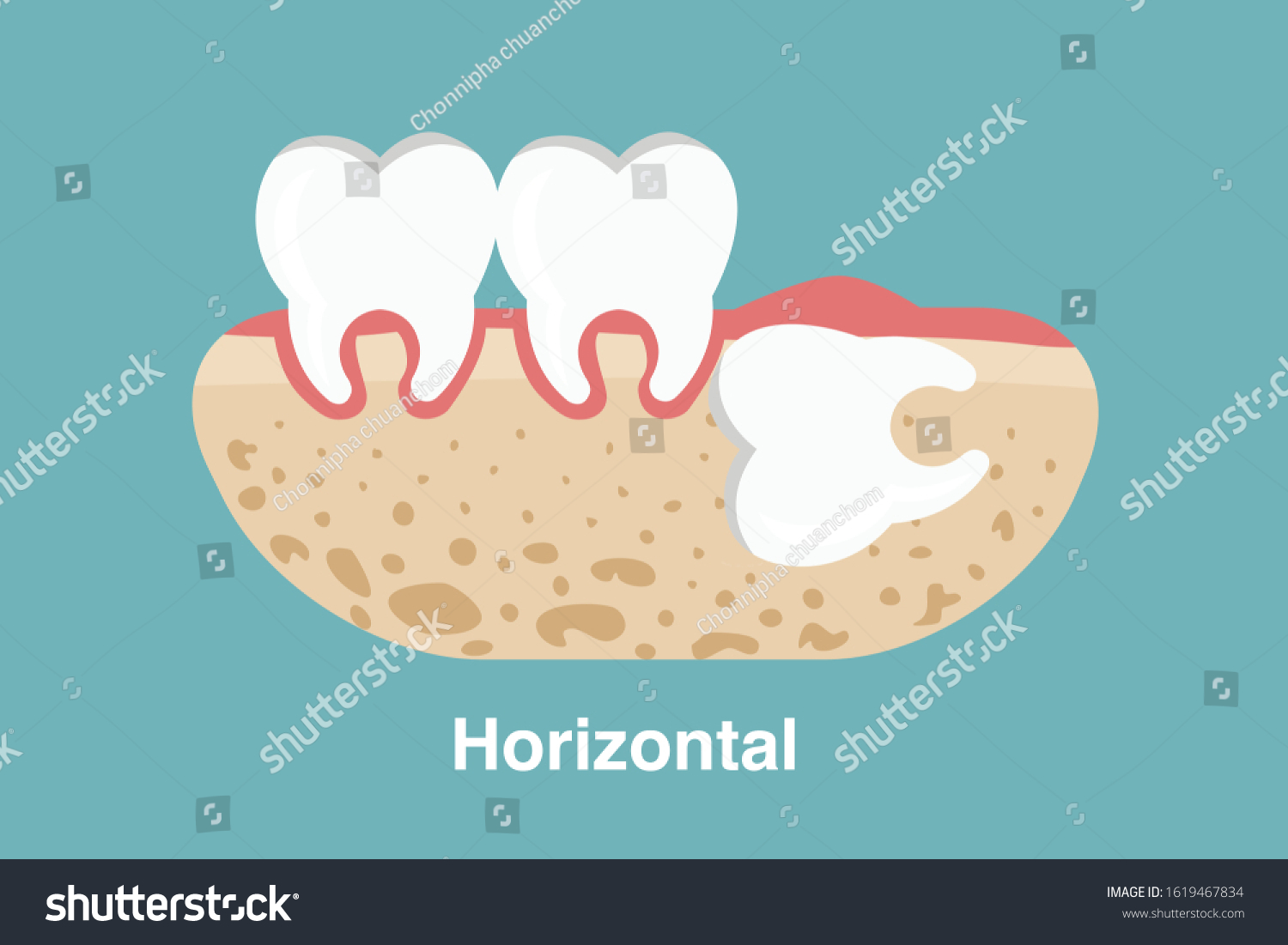 Wisdom Tooth Horizontal Impaction Illustration Vector Stock Vector ...