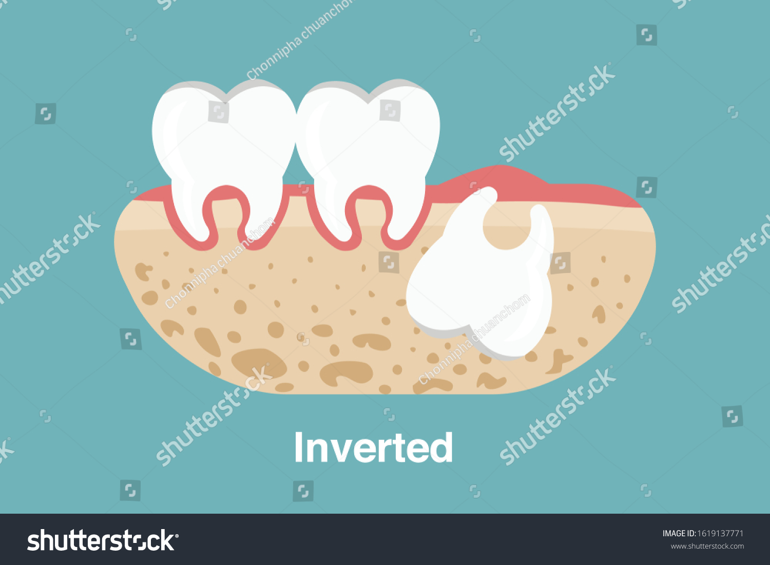 Wisdom Tooth Inverted Impaction Illustration Vector: vector de stock ...
