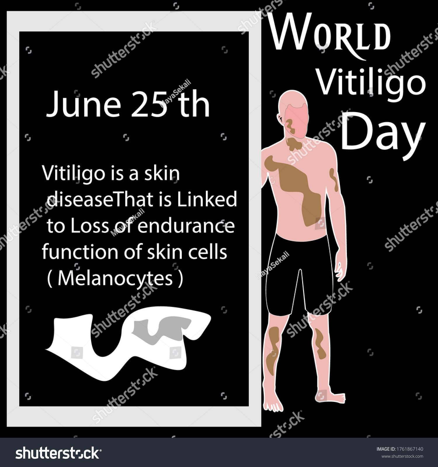 World Vitiligo Day Infographics Illustration Vector: เวกเตอร์สต็อก ...