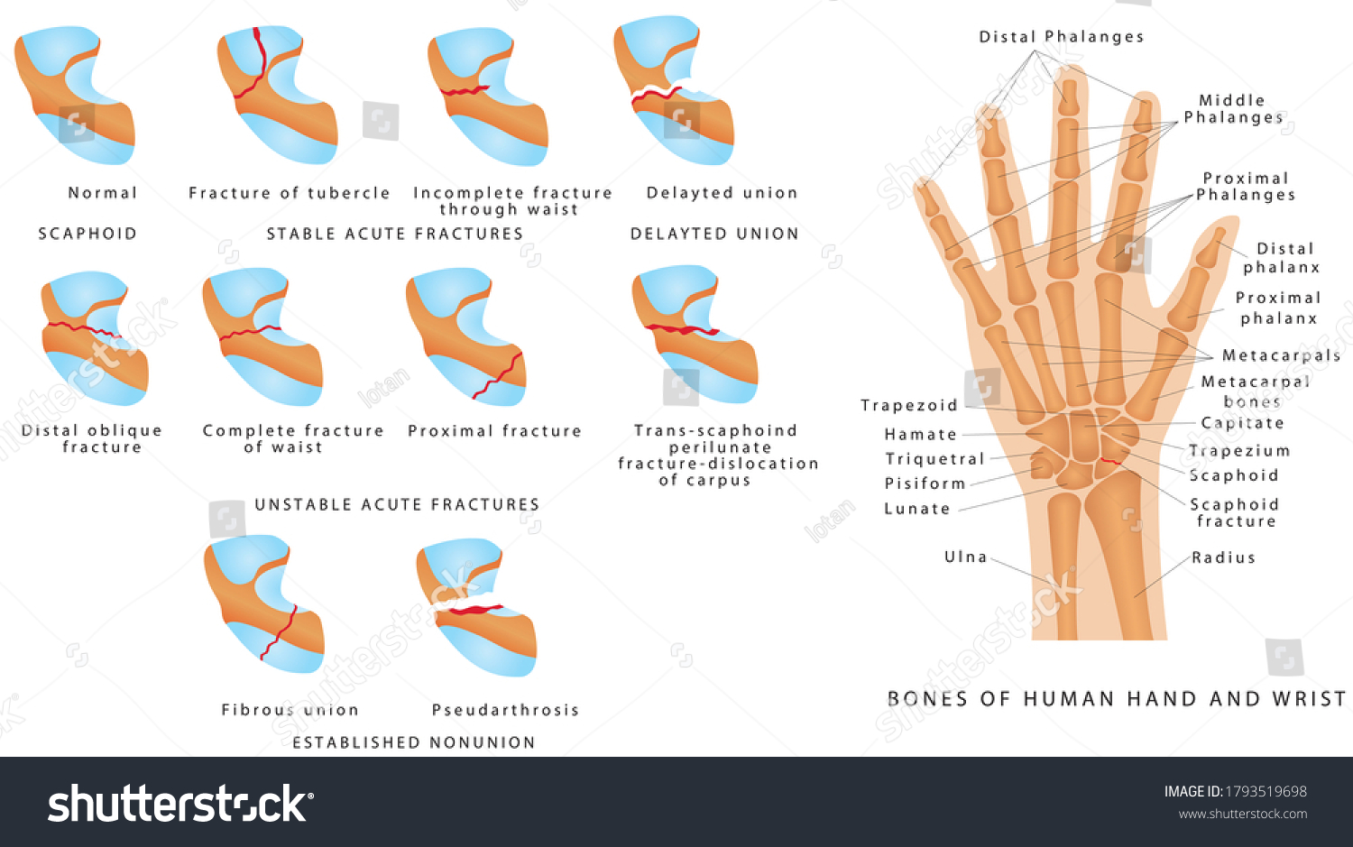 Wrist Fracture Scaphoid Classification Scaphoid Fractures Stock Vector ... Wrist Fracture Scaphoid Classification Scaphoid Fractures Stock Vector ...